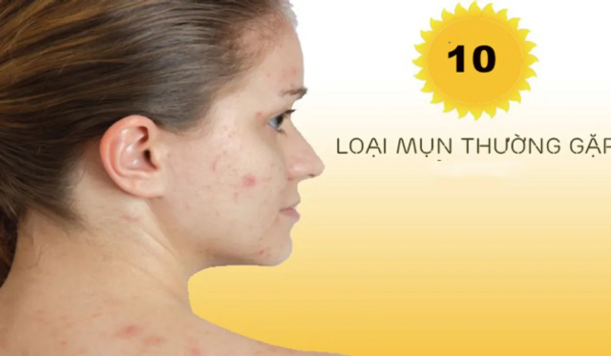 Tìm hiểu về các loại mụn trên khuôn mặt thông qua hình ảnh