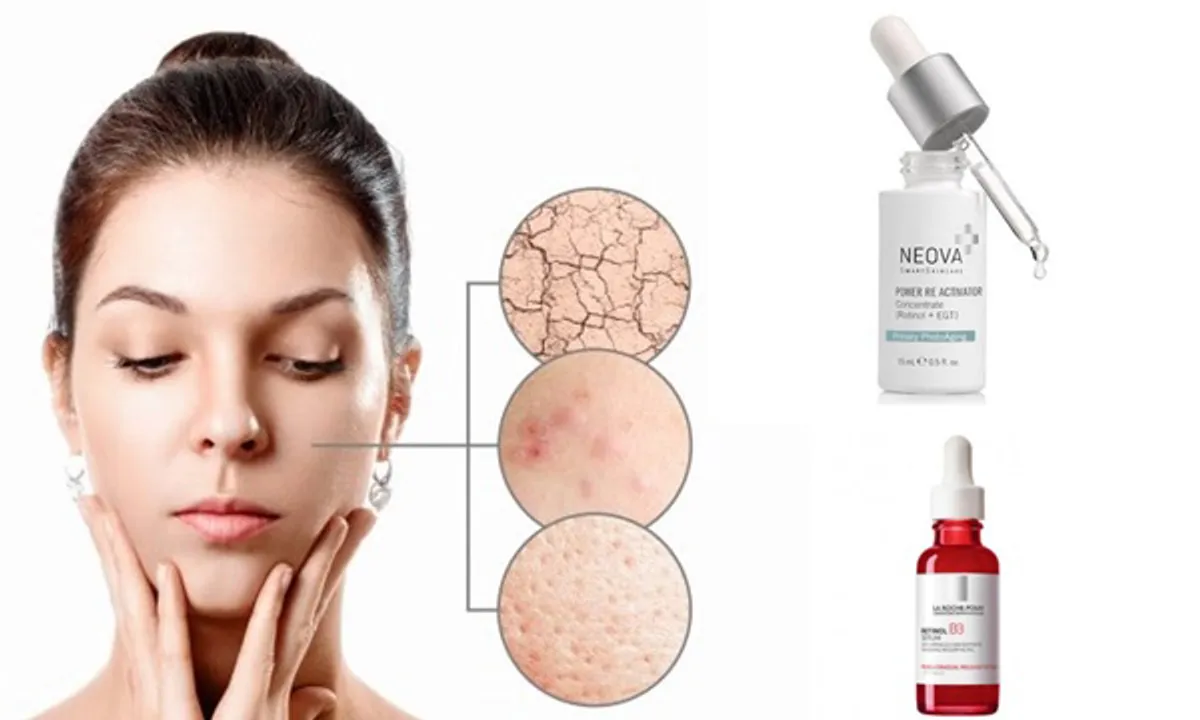 Các loại serum trị mụn da khô ẩn chứa trong skincare routine của bạn